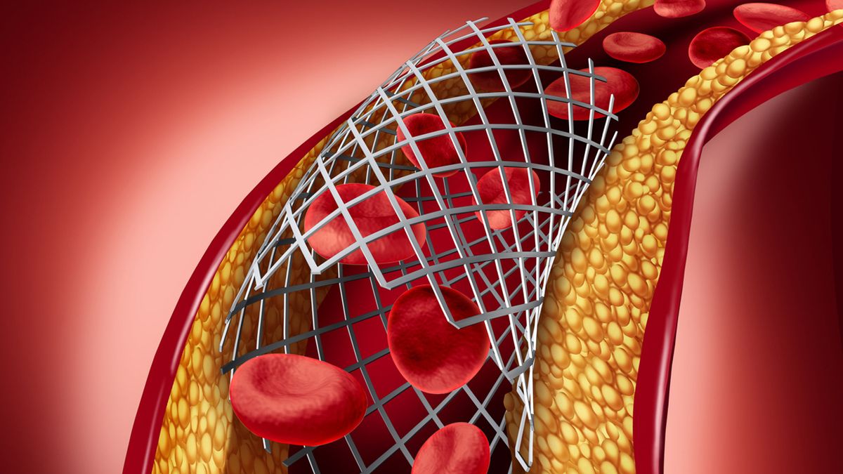 Se colocan más de 75 stents por día en la Argentina
