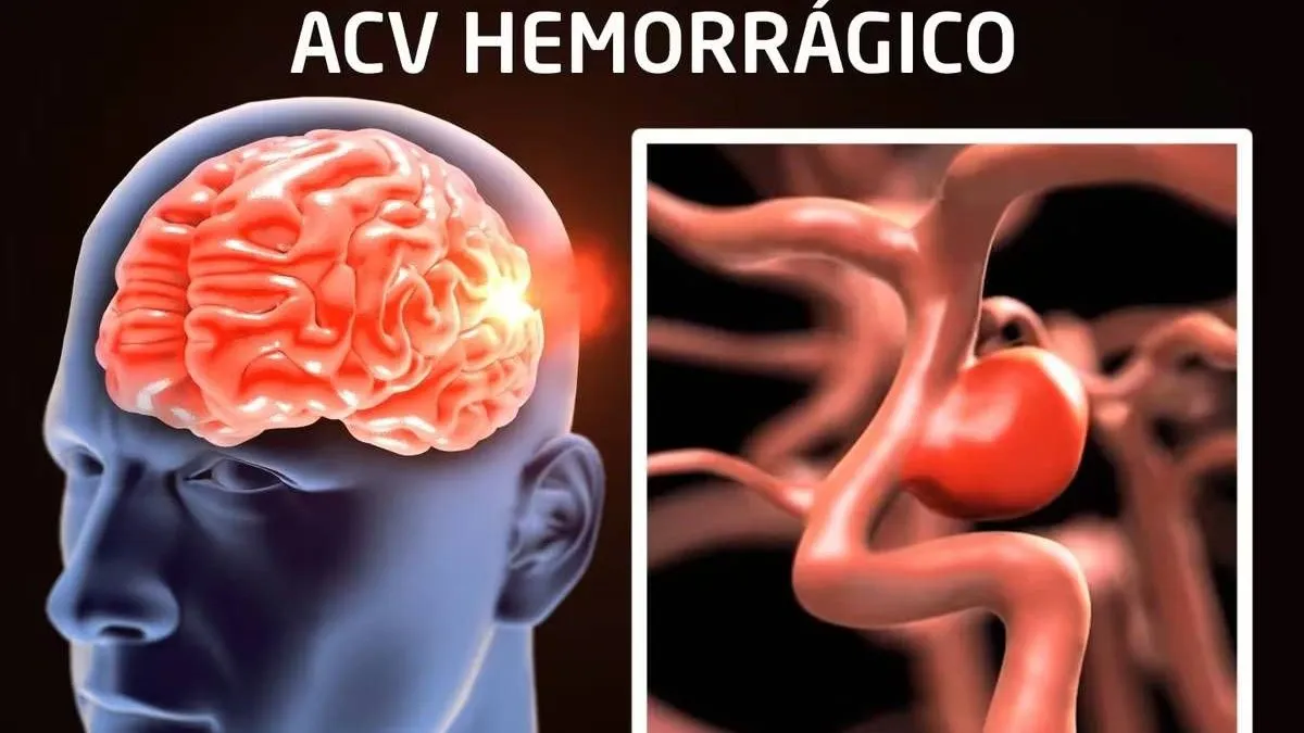 Un moderno análisis de sangre podría detectar un tipo peligroso de ACV