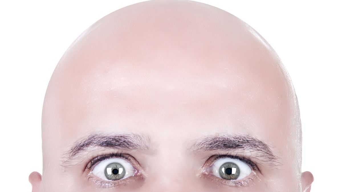 ¿Por qué hay jóvenes que sufren con la calvicie?