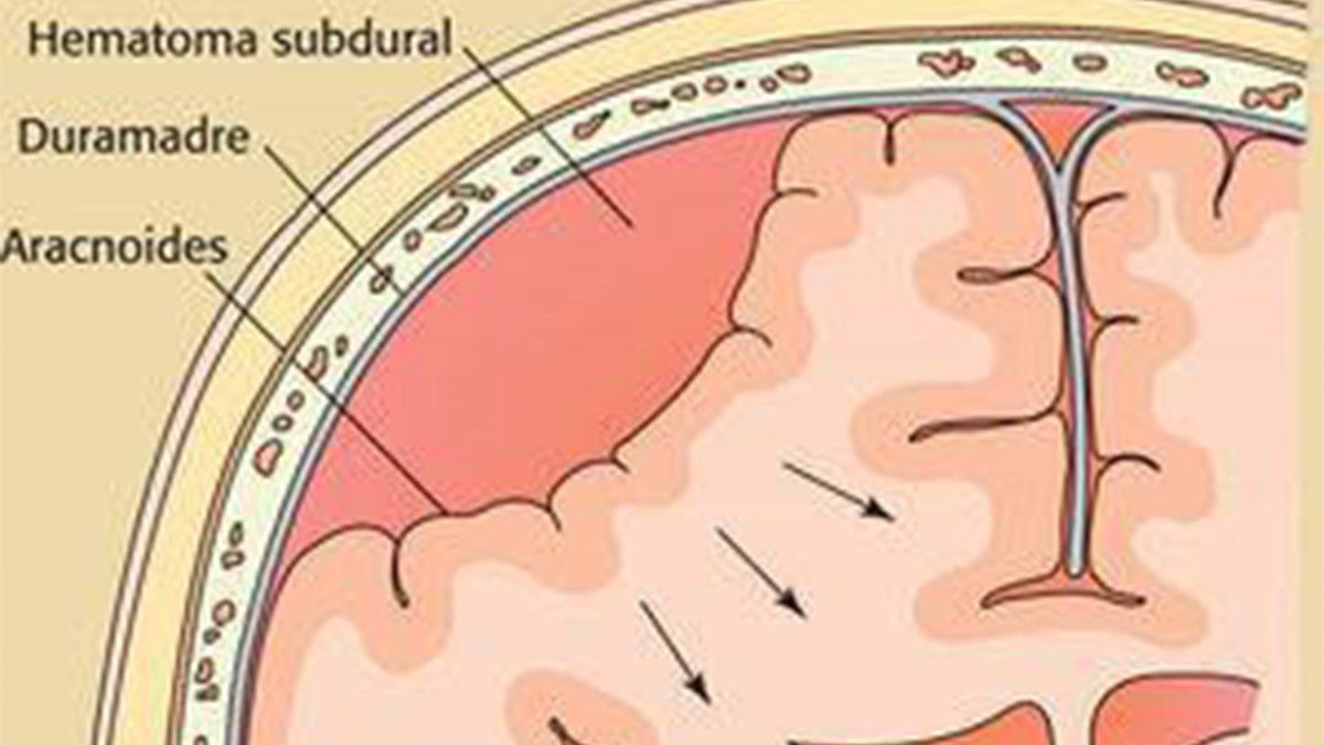 Últimas noticias sobre hematoma subdural