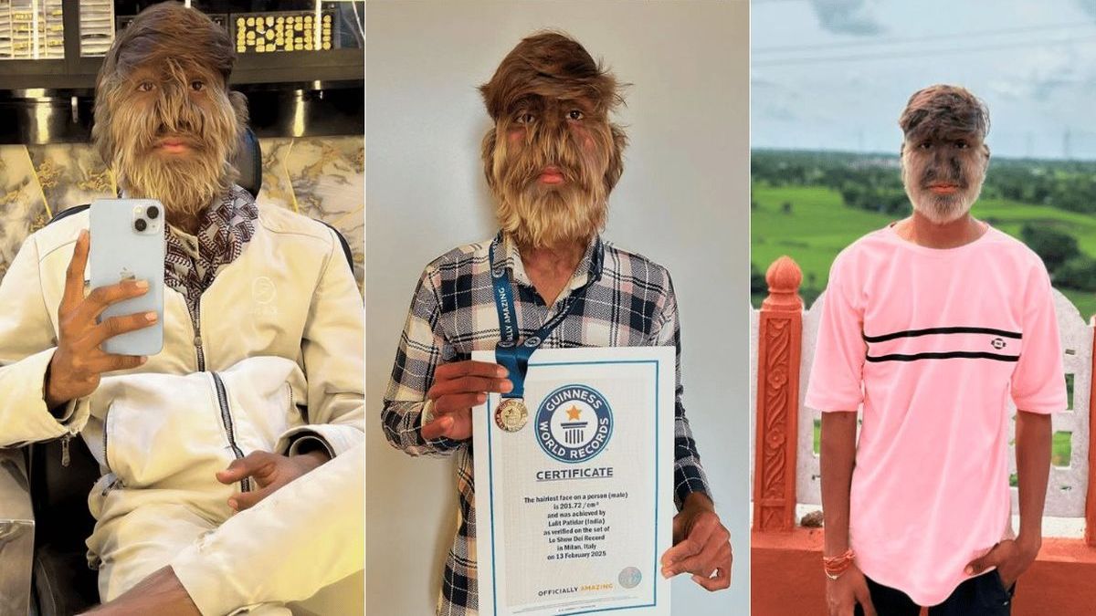 Él es Lalit Patidar, el humano con la cara más peluda del mundo